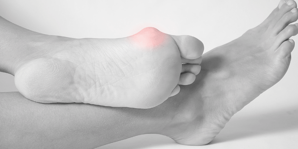Bunions - Foot Mechanics