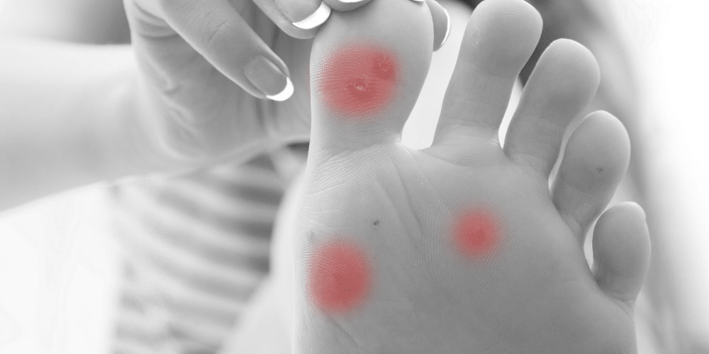 Corns and Callus? Our podiatrists can help - Foot Mechanics